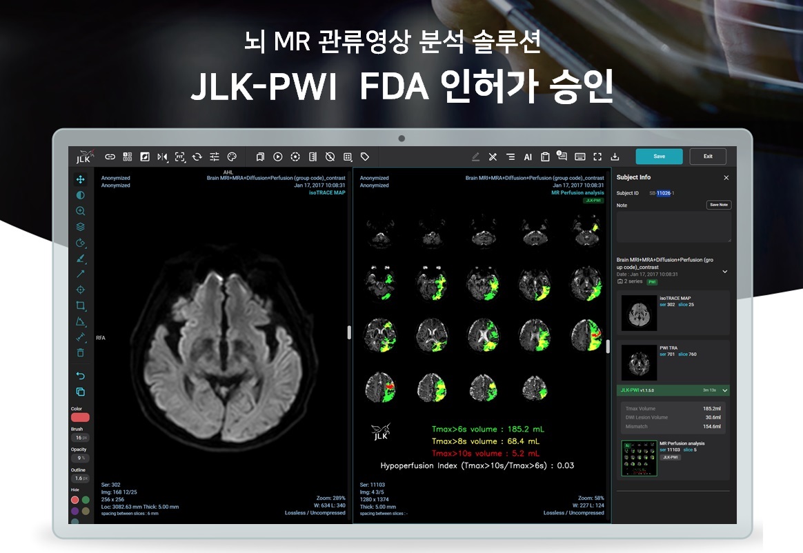 JLK, 'AI Perfusion Imaging Stroke Solution' Approved by US FDA